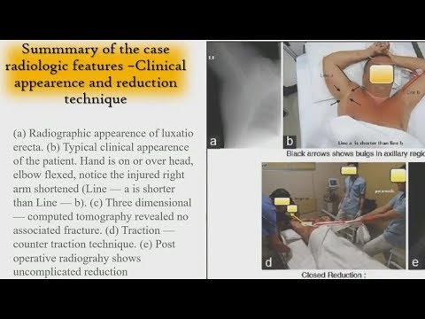 Luxatio Erecta (Inferior Glenohumeral Joint Dislocation) - Shoulder ...