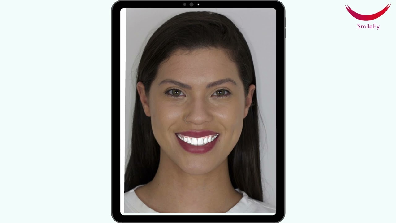 Direct Composite Restorations - Digital Workflow with Smilefy
