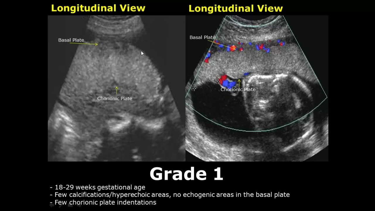 Placental Grading On Ultrasound | Grade 0, 1, 2, 3 Placenta USG