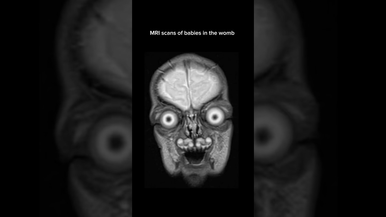 MRI scans of babies in the womb