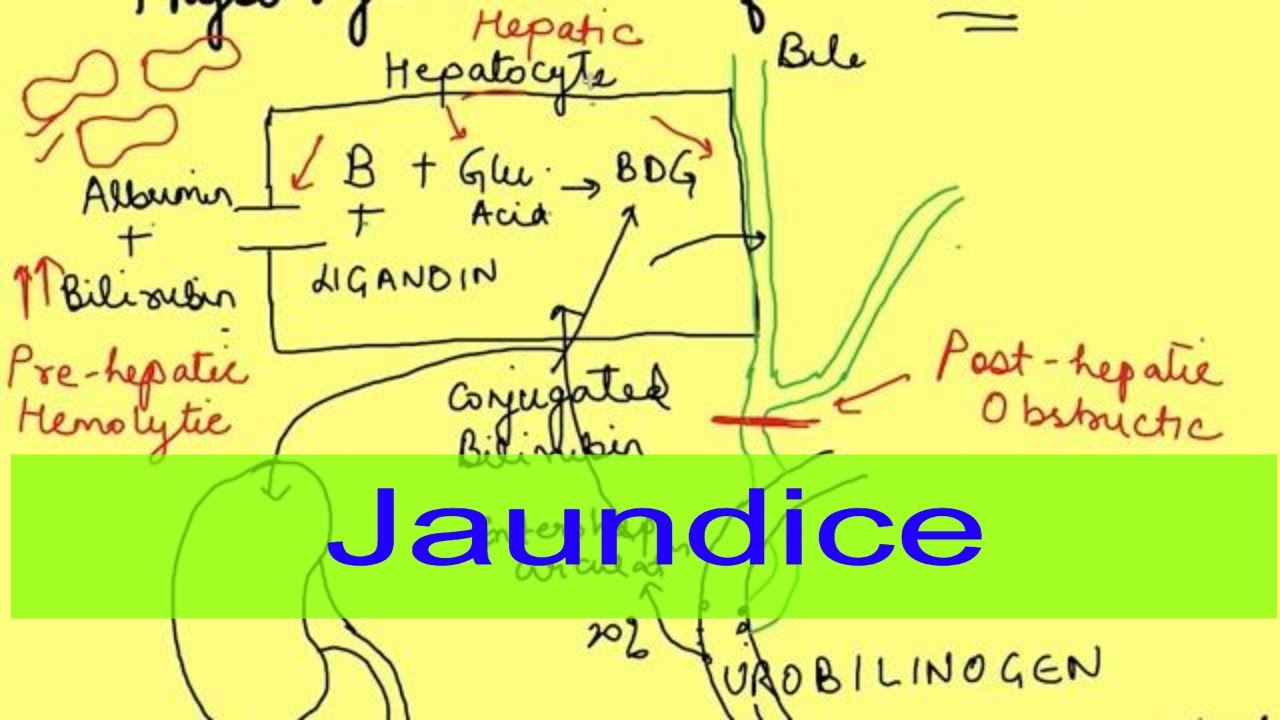 What is the difference between obstructive jaundice and hepatocellular ...