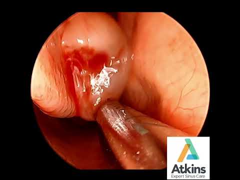 Right Nasal Polyp Removal With Shaver