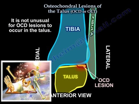Osteochondral Lesions Of The Talus - Everything You Need To Know - Dr. Nabil Ebraheim