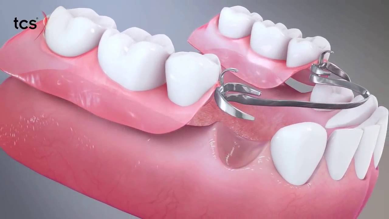 Flexible Partial Dentures Animation Video