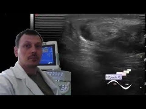 Pediatric Scrotal ultrasound - Hypoplasia of the testicle, torsion of the spermatic cord