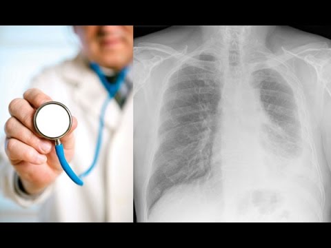 mesothelioma lawyers | Mesothelioma lawyer l Mesothelioma survival rates 2015