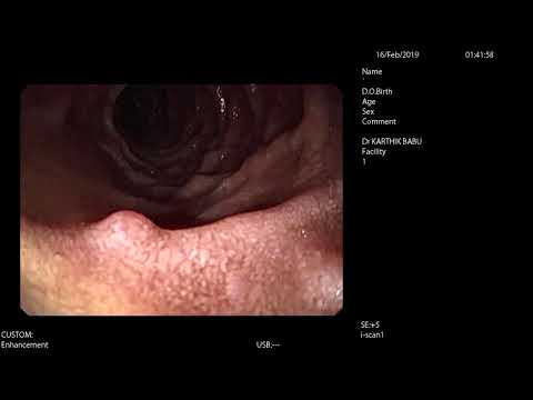 multiple polyps in stomach and duodenum