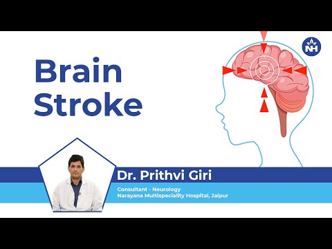 Brain Stroke: Signs & Treatment Explained