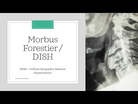 Morbus Forestier / DISH (Diffuse idiopathic skeletal hyperostosis) [Essential medicine]