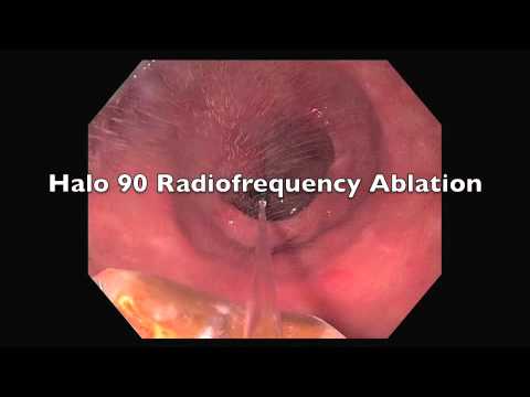 RFA of Bleeding AVM