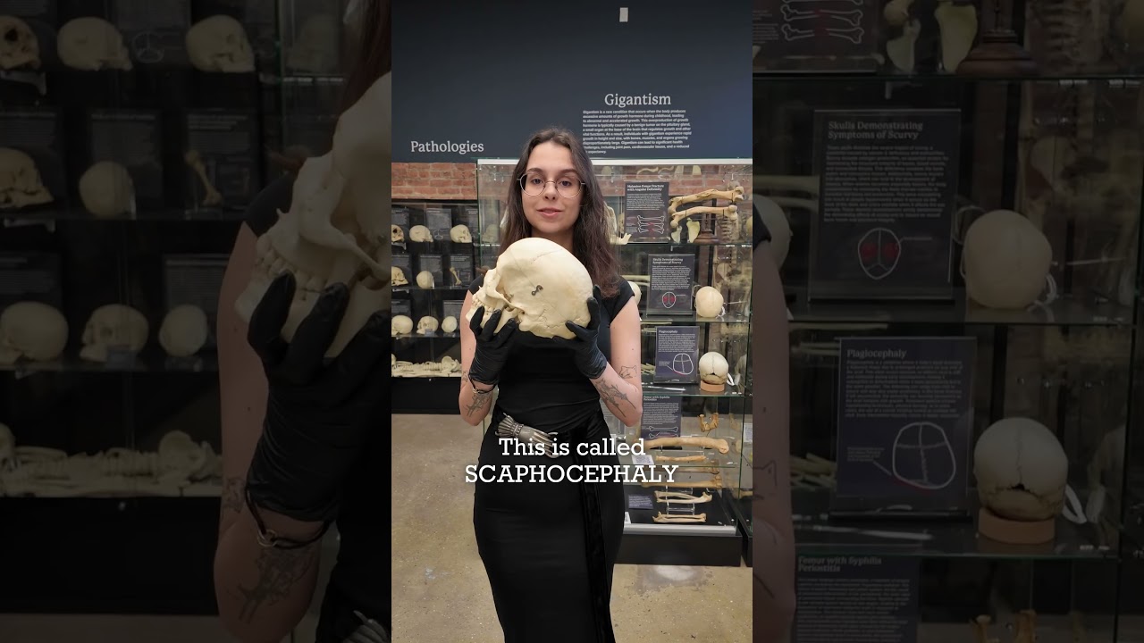 What is Craniosynostosis