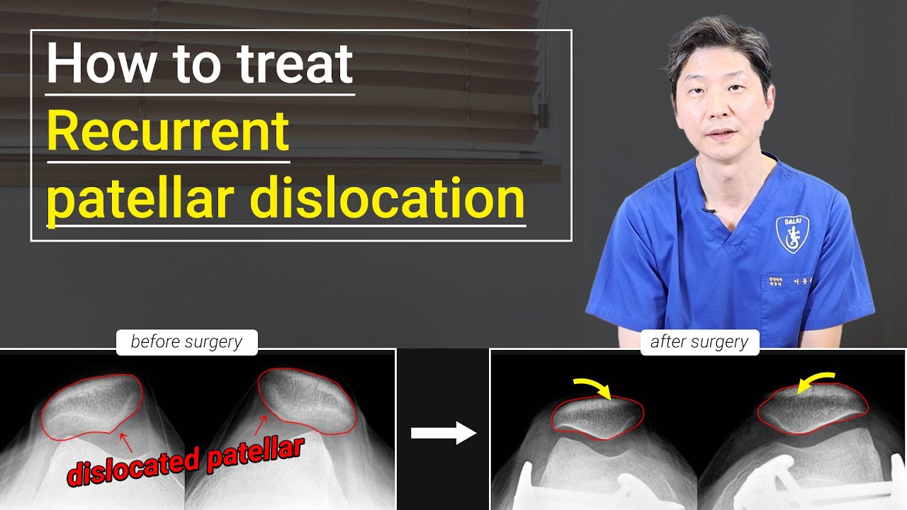 How to treat recurrent patellar dislocation?👨‍⚕️