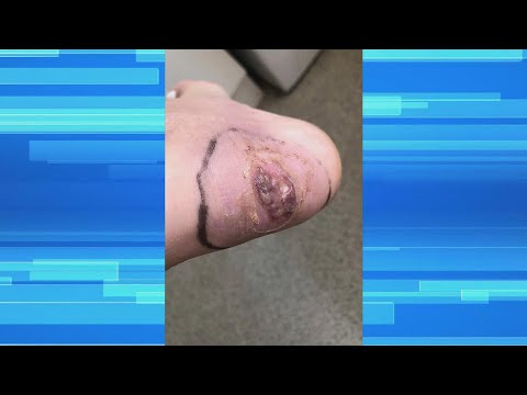 One Woman’s Blister Turns into Sepsis!
