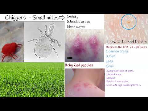 Chiggers bite - red bugs, harvest mites, symptoms and treatment.