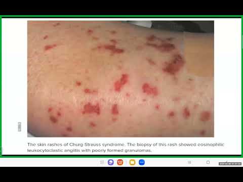 Discussion on Loefflers syndrome, TRIAGING in medicine and DKA