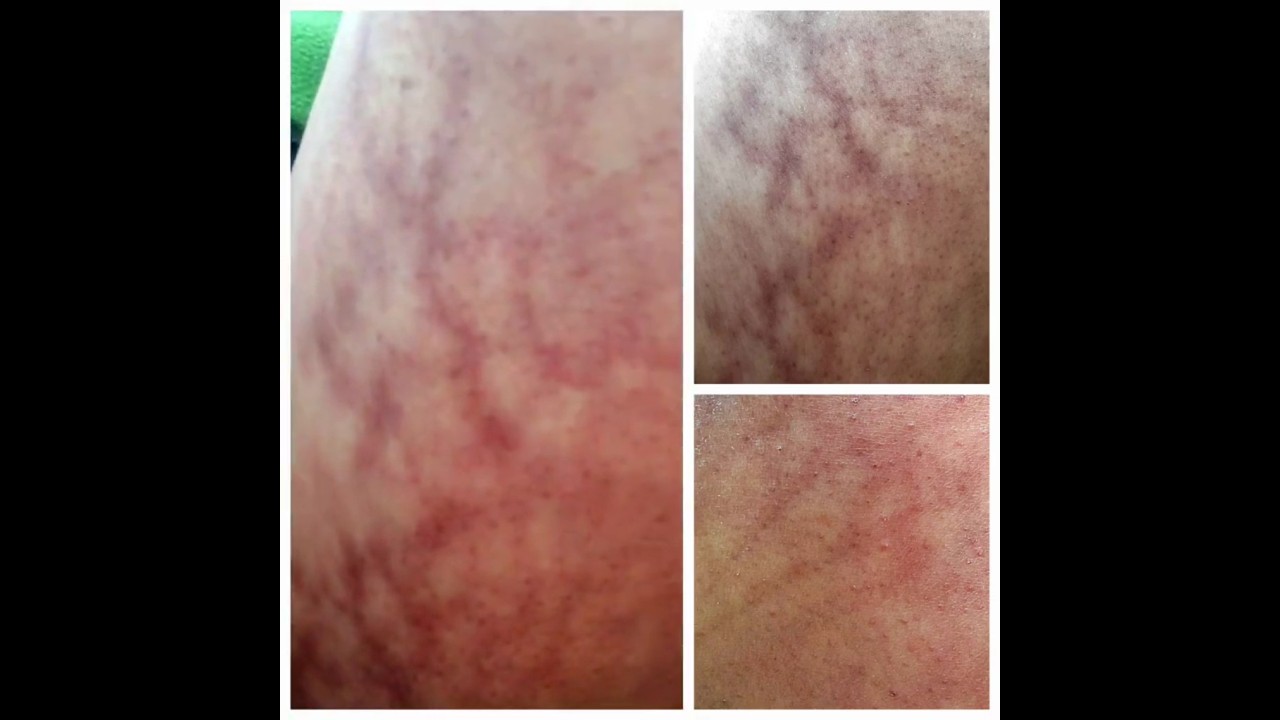 poor blood circulation long work hrs: #mottled #skin livedo reticularis