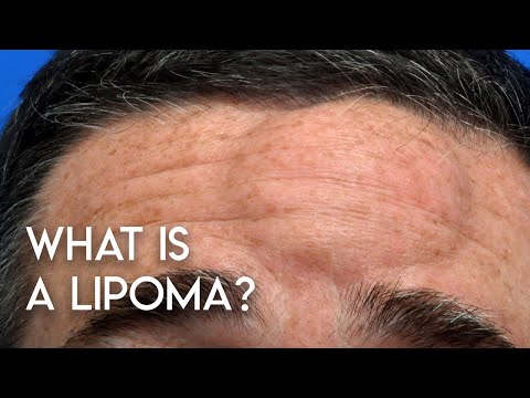 What is a Lipoma?