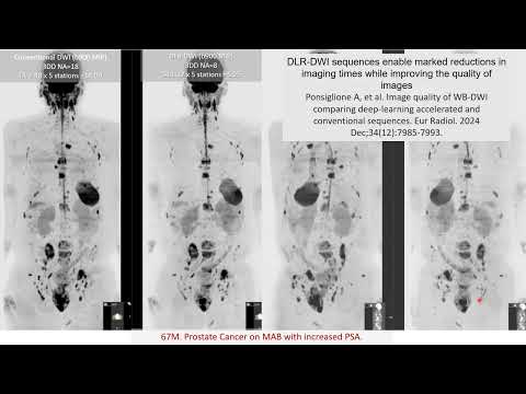 WB-MRI for Prostate Cancer - NotebookLM Discussion