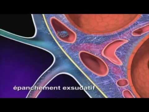 Epanchement pleural