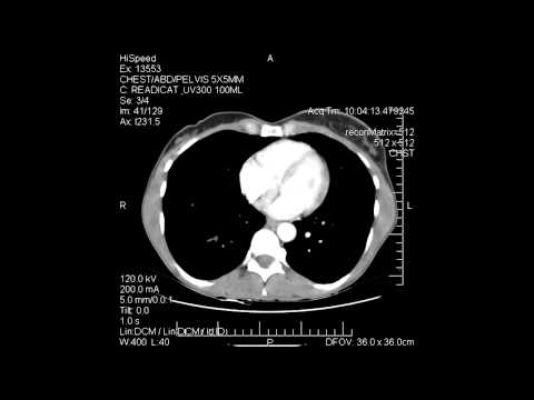 CT Scan of Chest, Abdomen, Pelvis