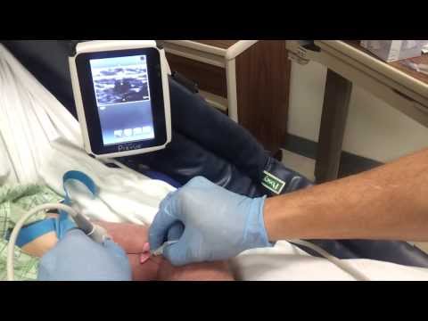 PIV insertion with Preview ultrasound