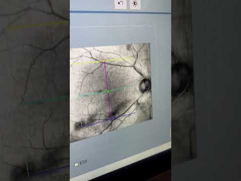 LASIK induced vitreous floaters taken with Optical Coherence Tomography (OCT).