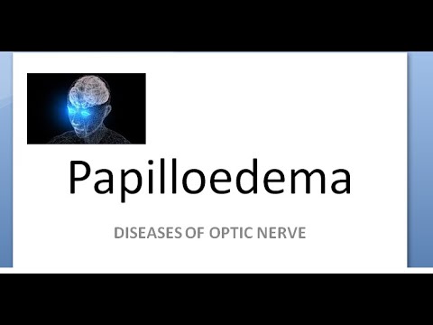 Ophthalmology Papilledema amaurosis fugax sometimes loss of vision cant see Hayreh theory