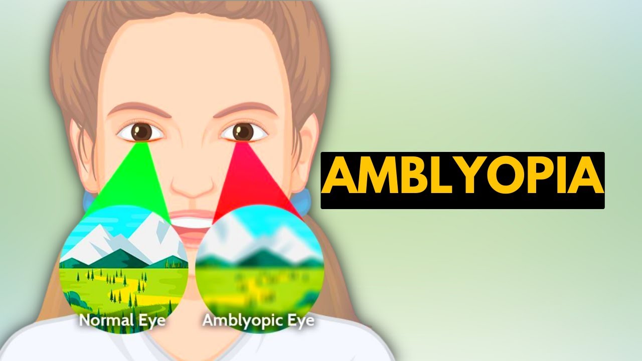 Amblyopia, Causes, Signs and Symptoms, Diagnosis and Treatment.