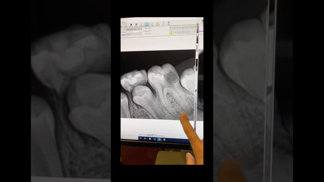No cbct. #dentists #dentalprosthesis #dentalcare #rootcanaltherapy #dentalartistry