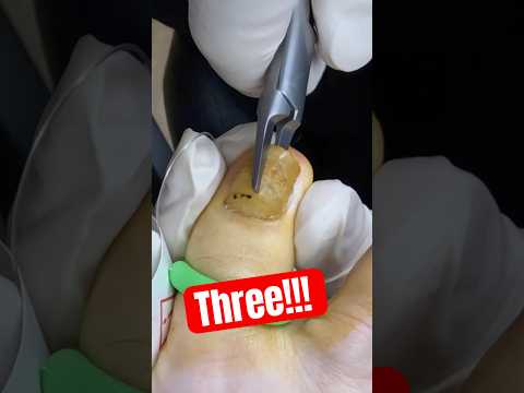 Fungus Toenail Treatment 😳
