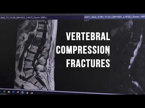 How to Identify Vertebral Compression Fractures