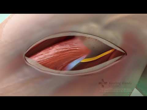 Common Peroneal Nerve Decompression
