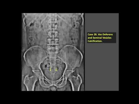 Vas Deferens and Seminal Vesicles Calcification (X-Ray)