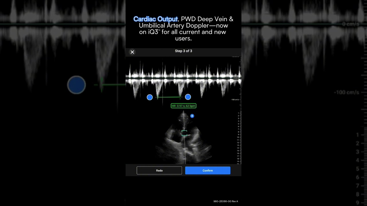 iQ3 New Features | Butterfly Network