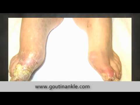The Ultimate Guide To Foods High In Uric Acid | Gout in Ankle