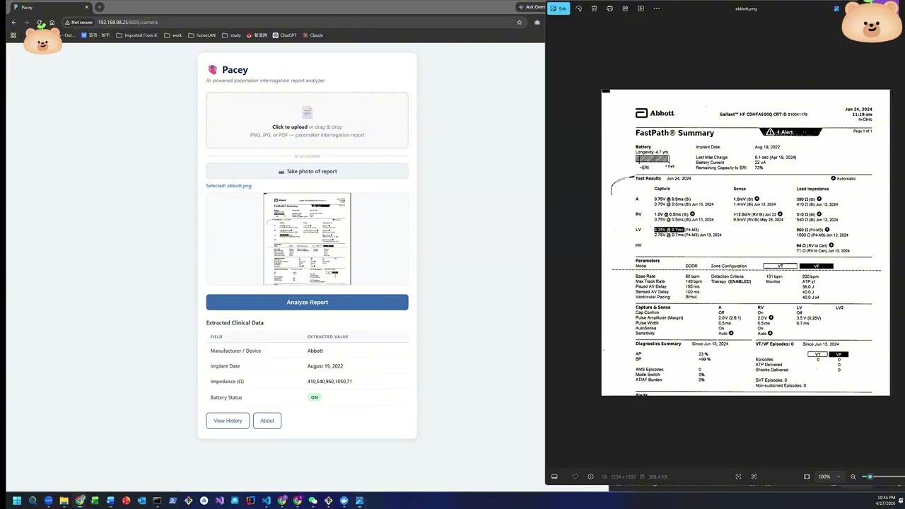 Pacey — AI Pacemaker Report Analyzer | UCI × UCI Medical Center Hackathon 2024