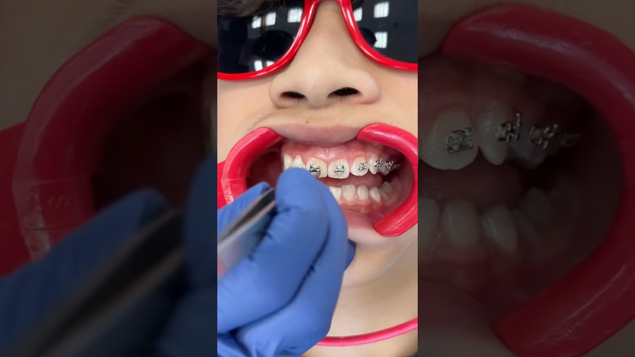 Watch how Metal Braces are put On