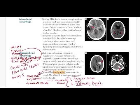 Lacunar STROKE