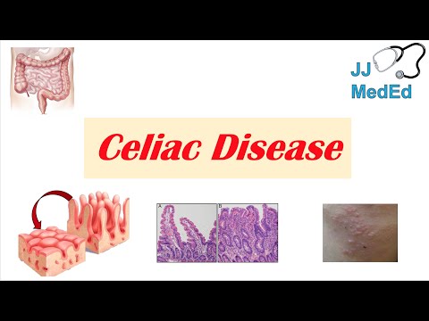 Celiac Disease (& Gluten Sensitivity): Risk Factors, Pathogenesis, Symptoms, Diagnosis, Treatment