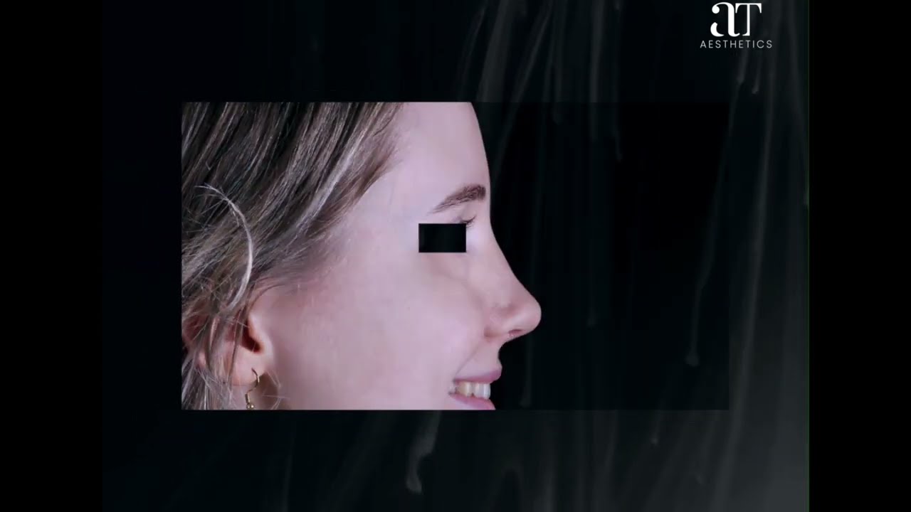 Rhinoplasty Before & After | Plastic Surgeon in Dubai - Dr Adnan Tahir