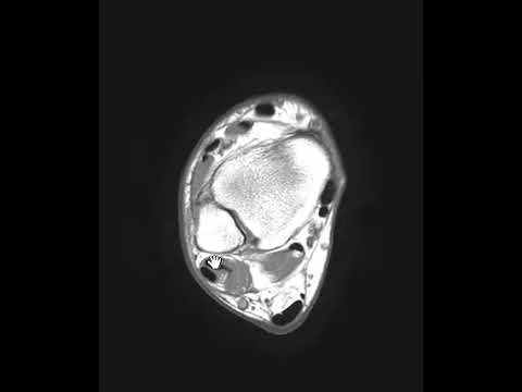 Peroneus brevis tendon longitudinal split tear