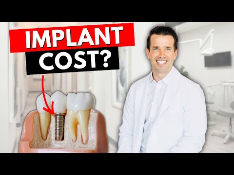 How much are Dental Implants 🦷