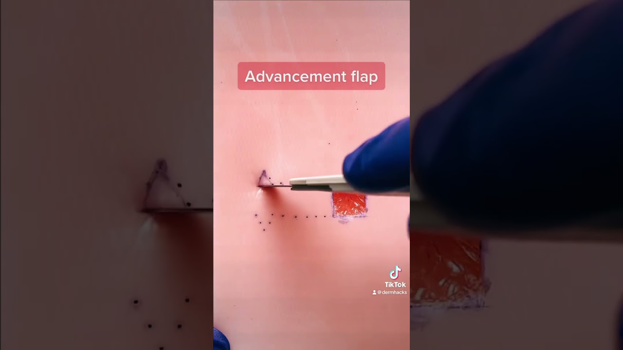 Advancement flap: incision