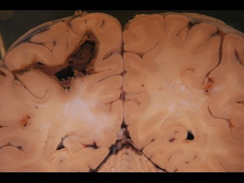 Hypertension - Pathology mini tutorial