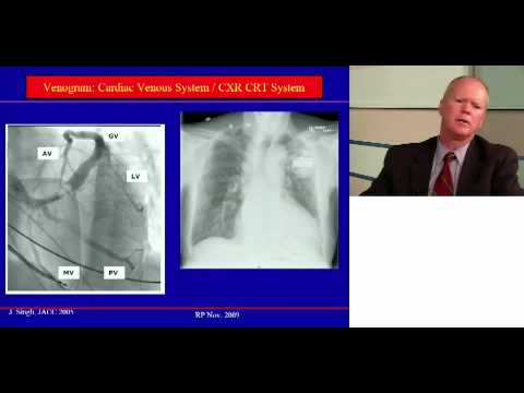 Long-term management of ischemic cardiomyopathy: focus on devices