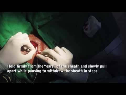 Peel-away of Sheath of Ventricular lead (Dual Chamber System)