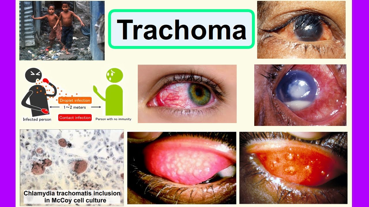 trachoma