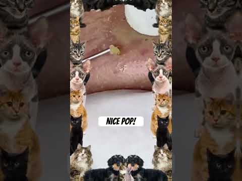 Wow! #pimple #pimplepopping #pimples #shortsfeed #shortvideo #shorts #short #youtube #youtubeshorts