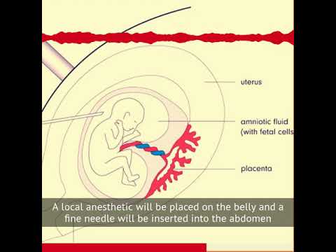 Explaining an amniocentesis - Interpret from Spanish to English