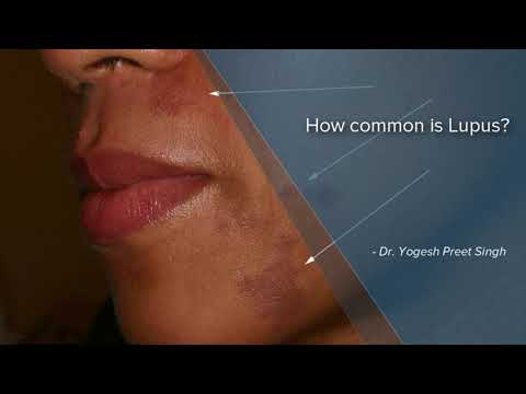 How common is Lupus? A discussion with Dr. Yogesh Preet Singh